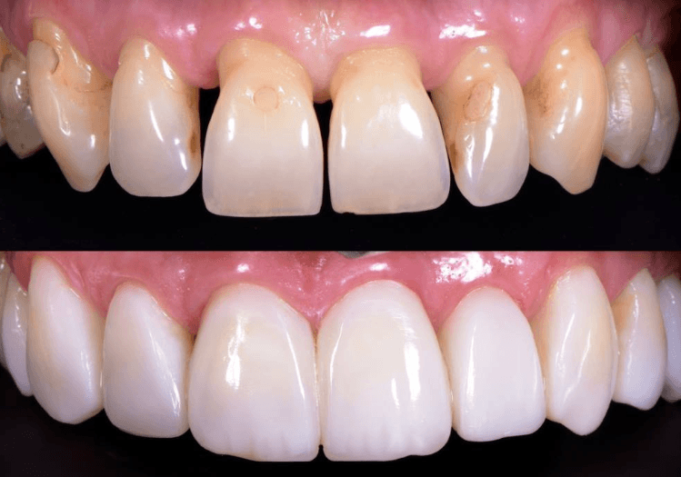 The Magic Of Dental Veneers!" Goodbye Dental Imperfections